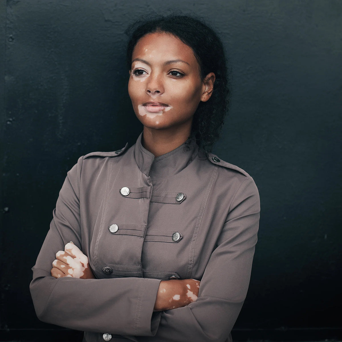 Genetic Hyperpigmentation: Spotting Pigmentation Disorders – Saian Skin ...
